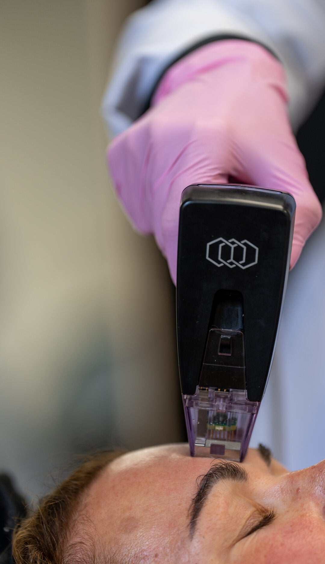 Morpheus8: Advanced Microneedling for Skin Rejuvenation – NDA Medical Spa